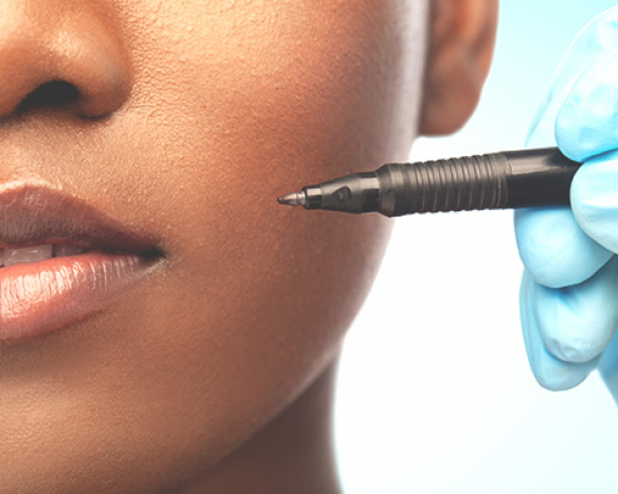 Injection nanofat needling chirurgie régénérative Clinic 135